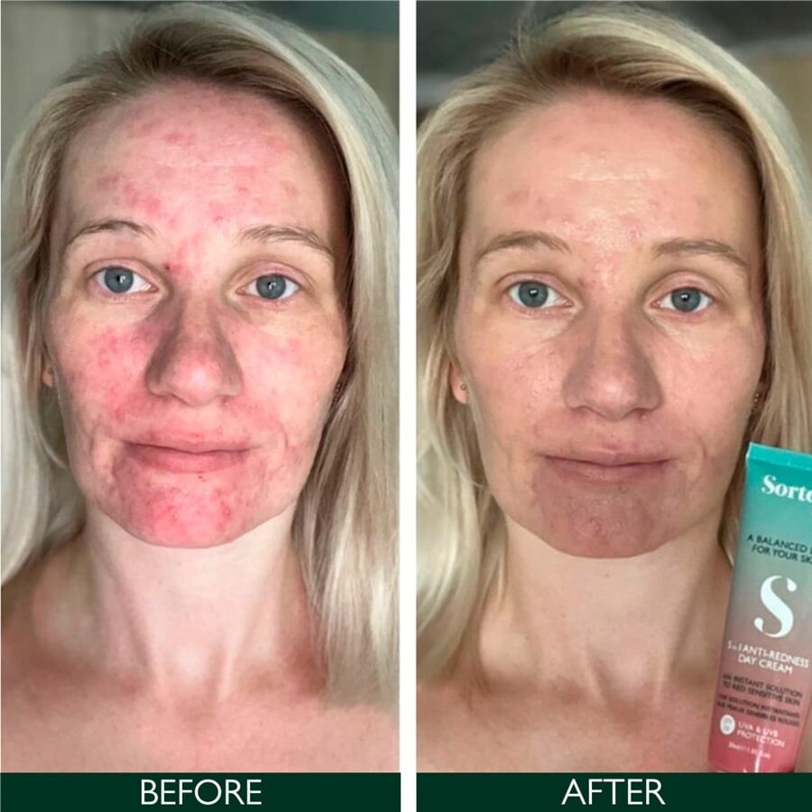 Køb Sorted Skin - 5 In 1 Anti-redness Day Cream - Spf50 30 Ml - Gucca.dk